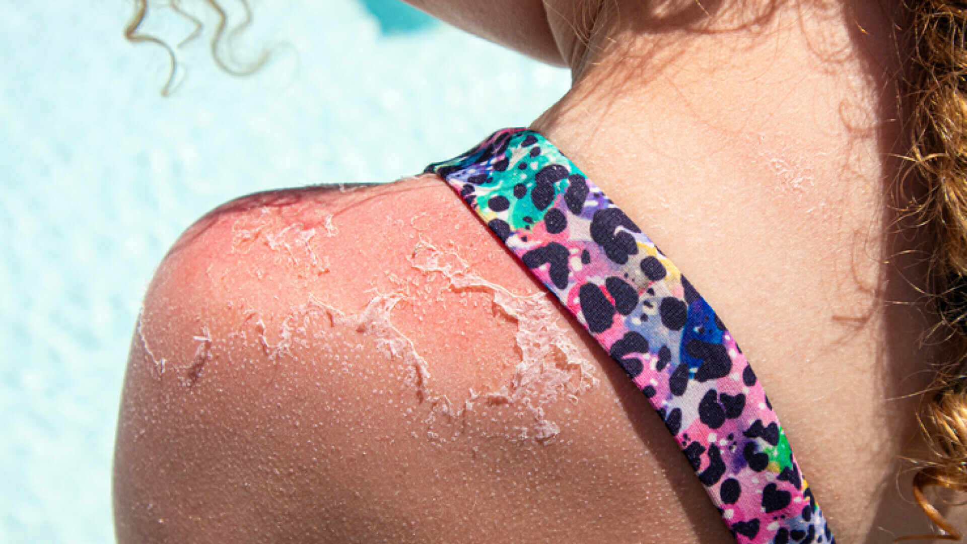 Što se doista događa s kožom kad dobijemo opekline od sunca?