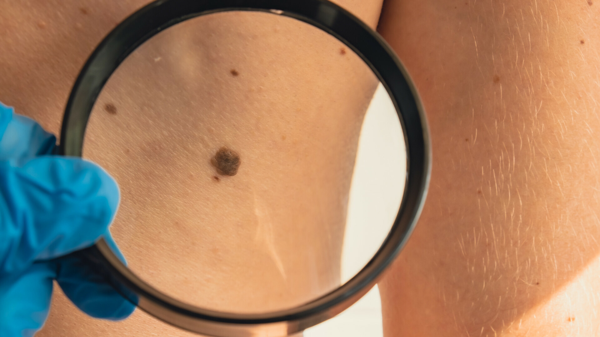 Znanstvenici rade na razvoju prijenosnog senzora za detekciju raka kože