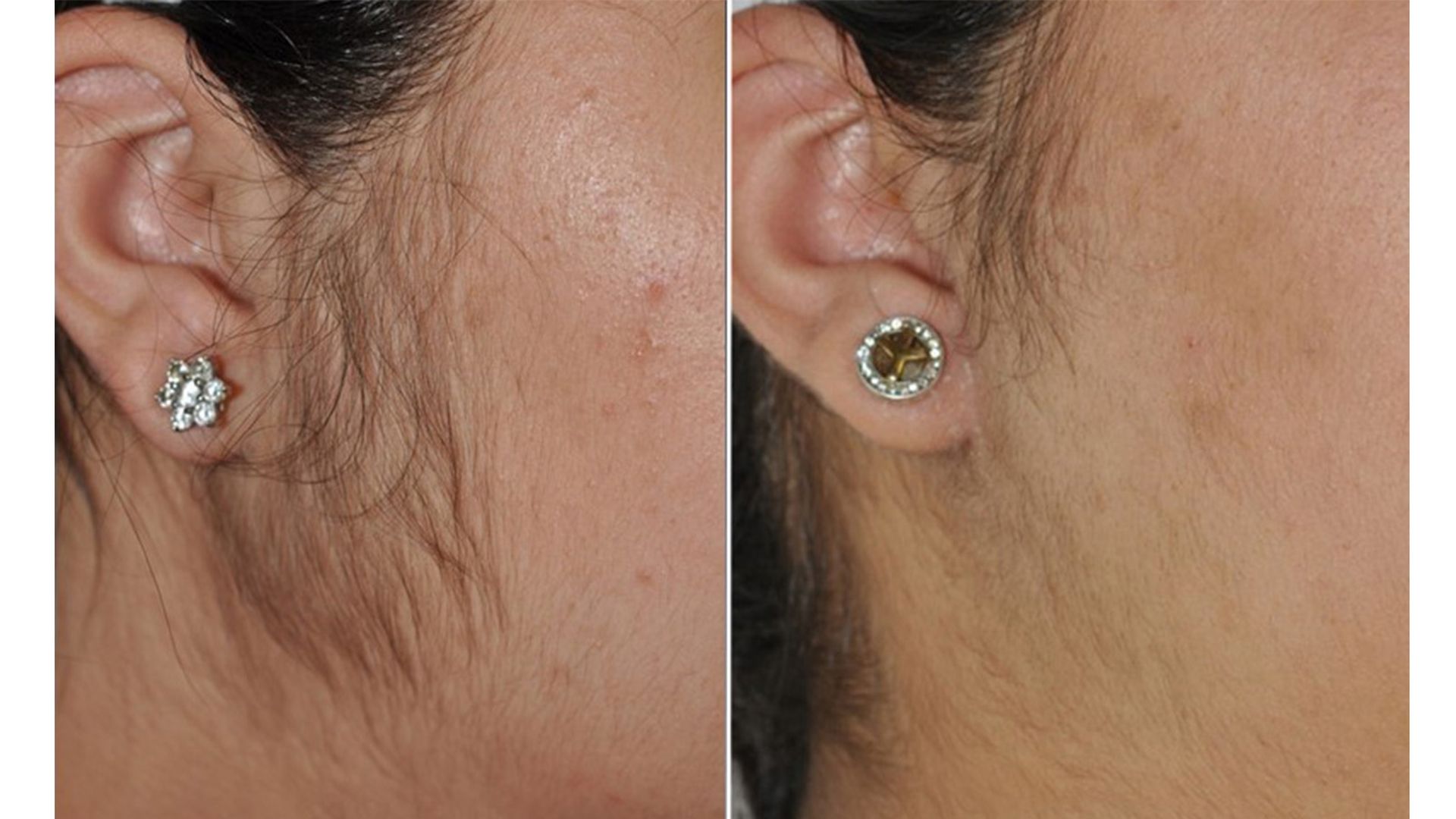 Iritacije kože i urasle dlake motivirale su Maju da pronađe novu metodu ...